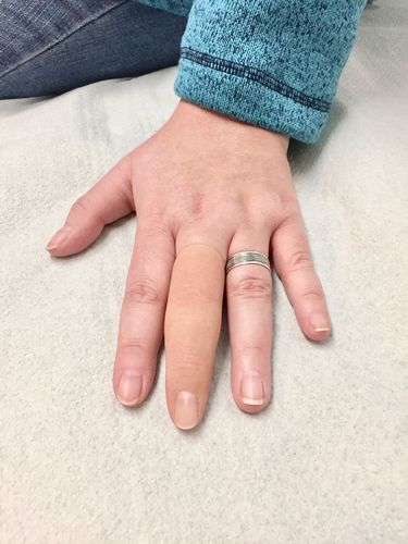 Individuelle Prothesen